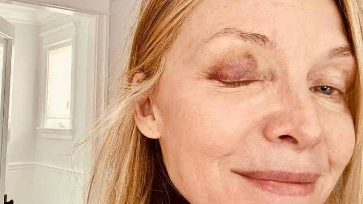 Michelle Pfeiffer aparece com olho roxo; entenda