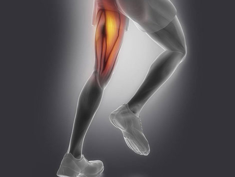 Distensão ou estiramento muscular